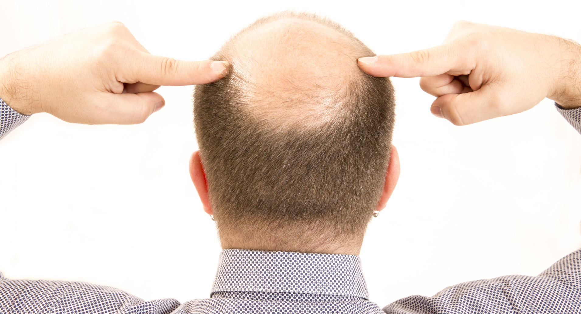 ¿qué es la alopecia? | Instituto Míriam Alcántara